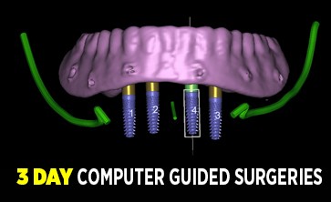 3-days-computer-guided-surgeries | Live Implant Training ™ Work on ...