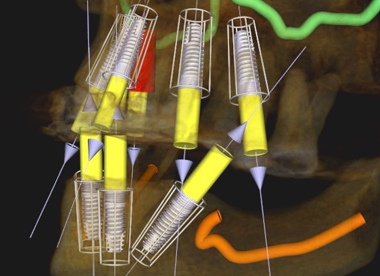 Live Implant Training ™ Work on Patients Dental Live Courses