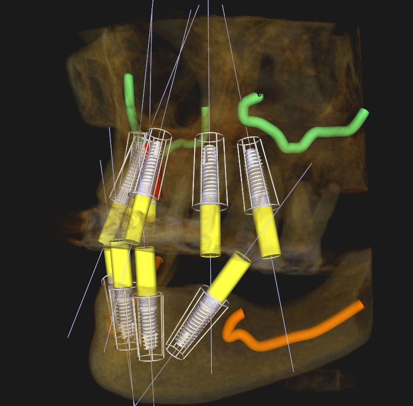 4 3d lateral | Live Implant Training ™ Work on Patients Dental Courses