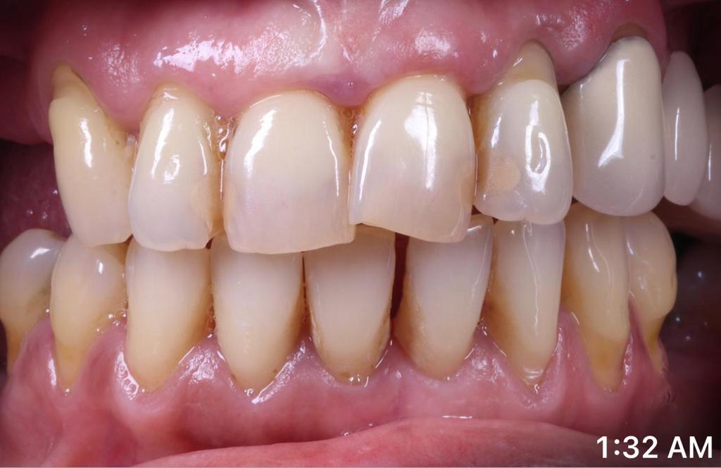 1 Full Arch Computer Guided | Live Implant Training ™ Work on Patients ...