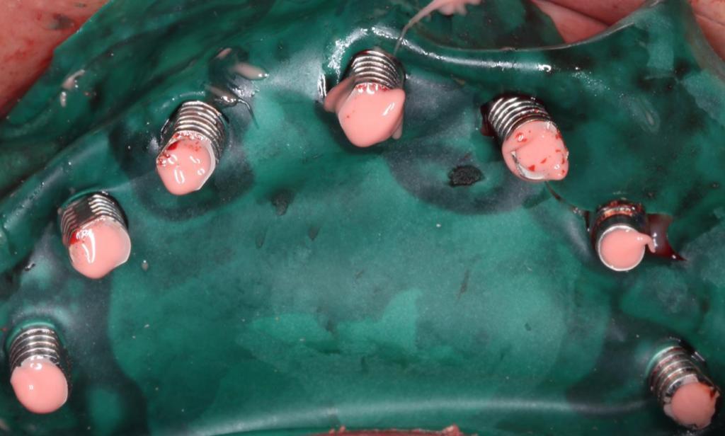 12 Full Arch Computer Guided IMMEDIATE LOADING TRAINING courses | Live ...