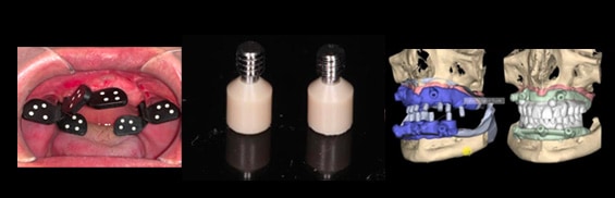 lit-us | Live Implant Training ™ Work on Patients Dental Courses