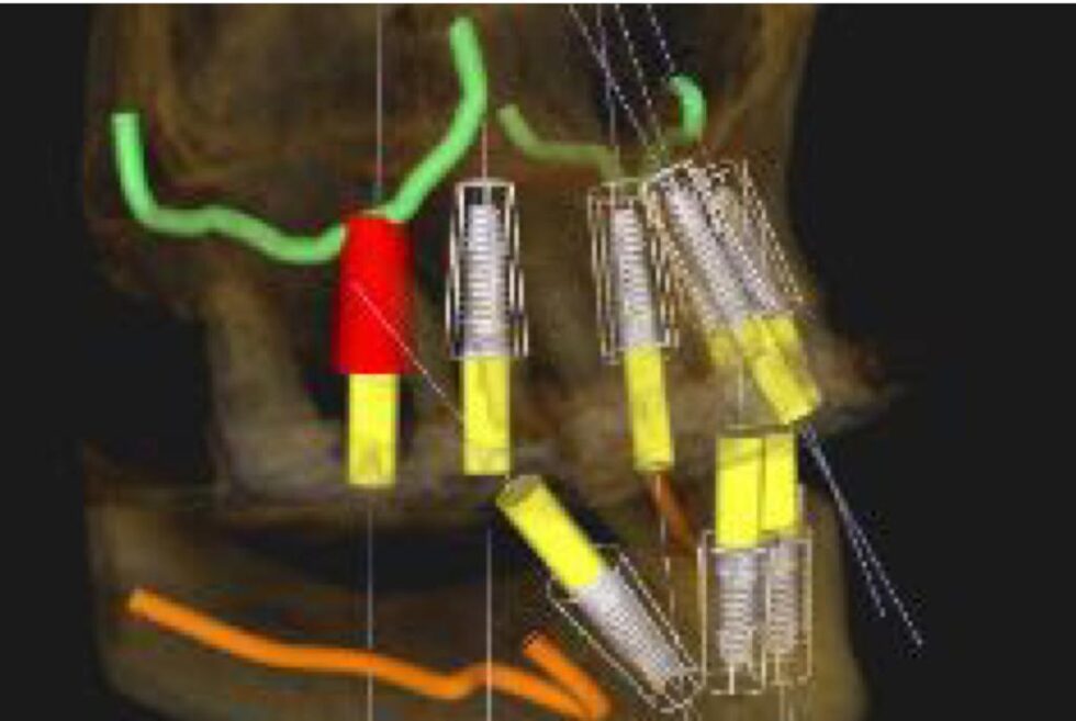 7 Day Live Implant Course Advance Bone Grafting Live Implant Training ...