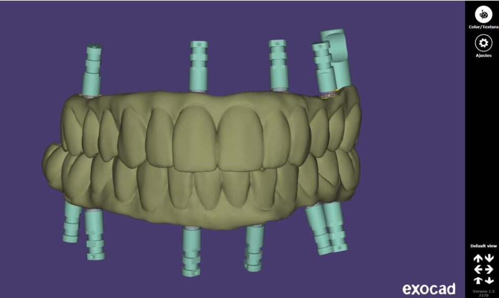 3D “BOOM COMBO” Full Arch Immediate Loading | Live Implant Training ...