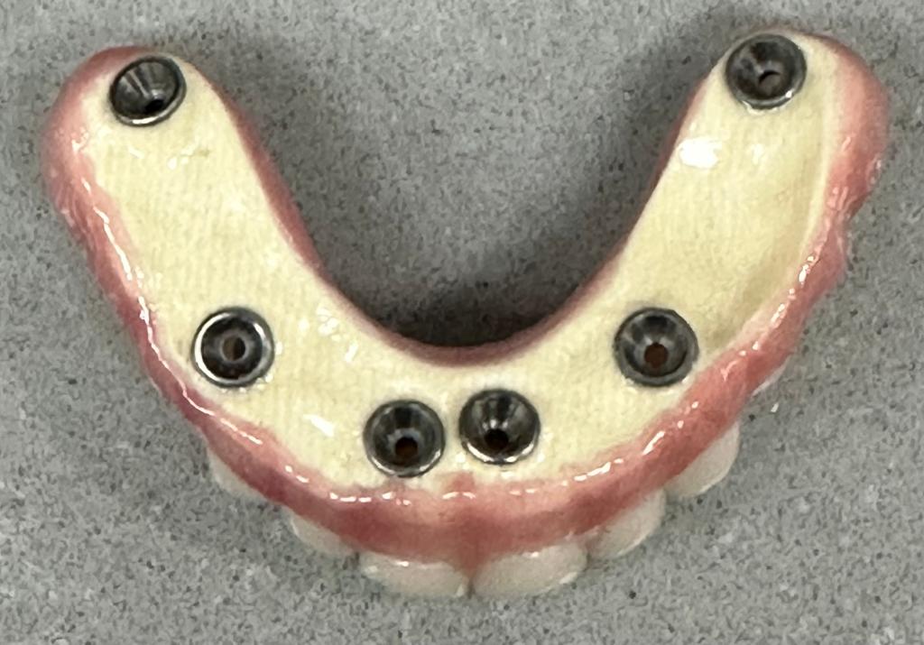 3D “BOOM COMBO” Full Arch Immediate Loading | Live Implant Training ...