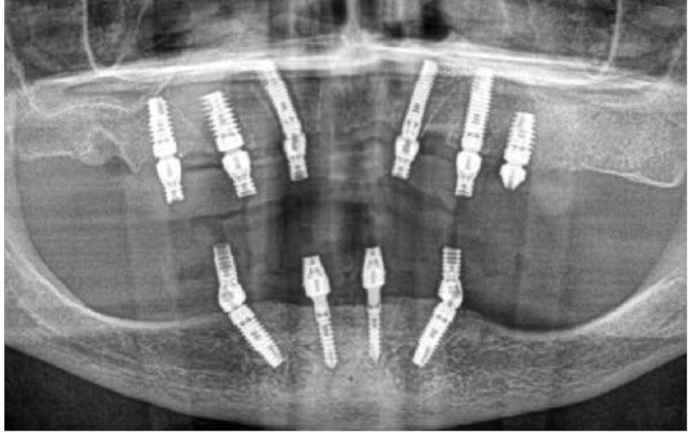 Dual Arch Smart on X full arches immediate loading | Live Implant ...